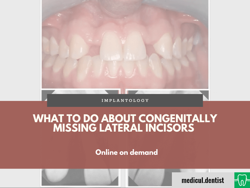 What to Do About Congenitally Missing Lateral Incisors (Online la ...